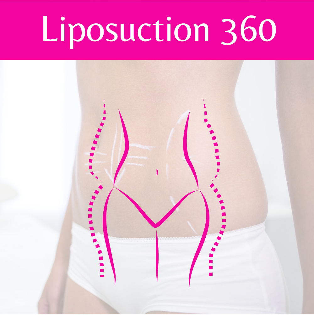 Liposuction 360 - True Beauty
